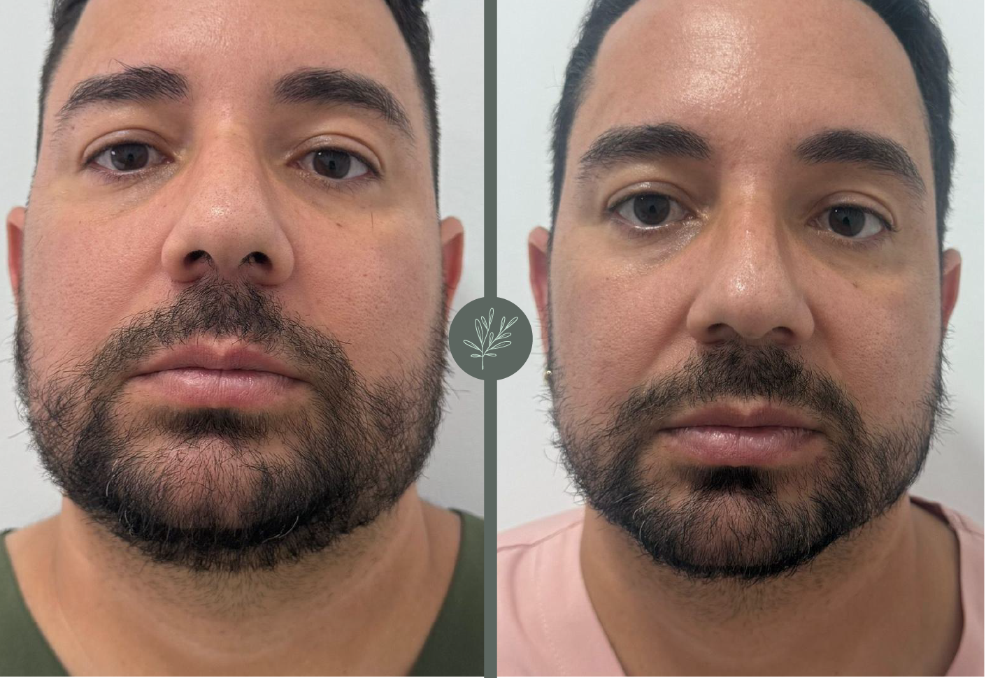 Tratamiento de Endoláser | Endolift Facial y Corporal | Depilife